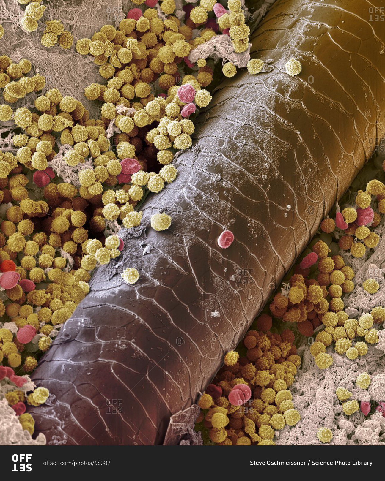 Pyoderma skin disease under a Color scanning electron micrograph. stock ...