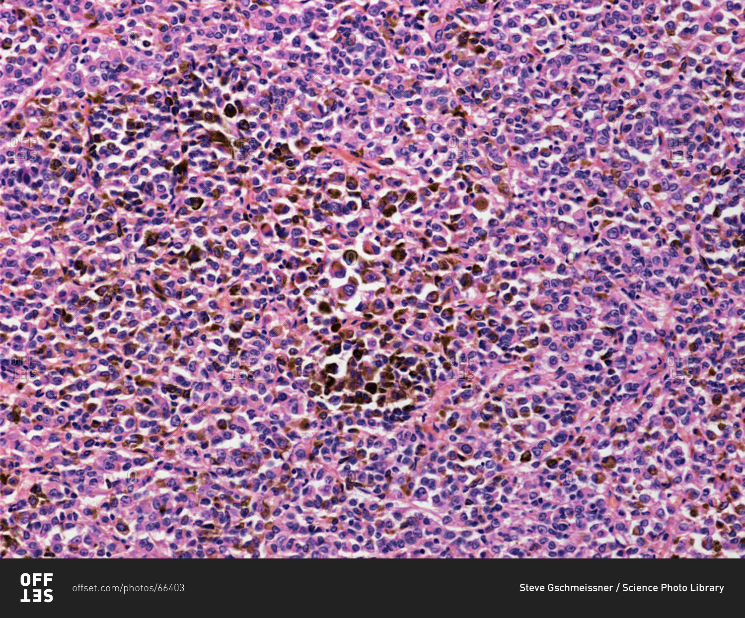 Light micrograph of a section through a metastatic malignant melanoma ...