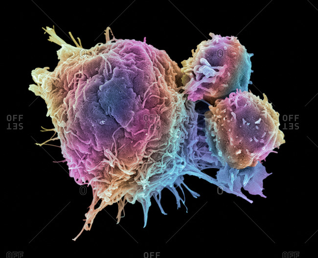 Cancer cell and T lymphocytes, SEM - Stock Image - Everypixel