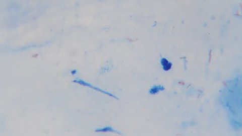 Afp Stain Show Microbacterium Tuberculosis Tb Stock Footage Video (100% ...