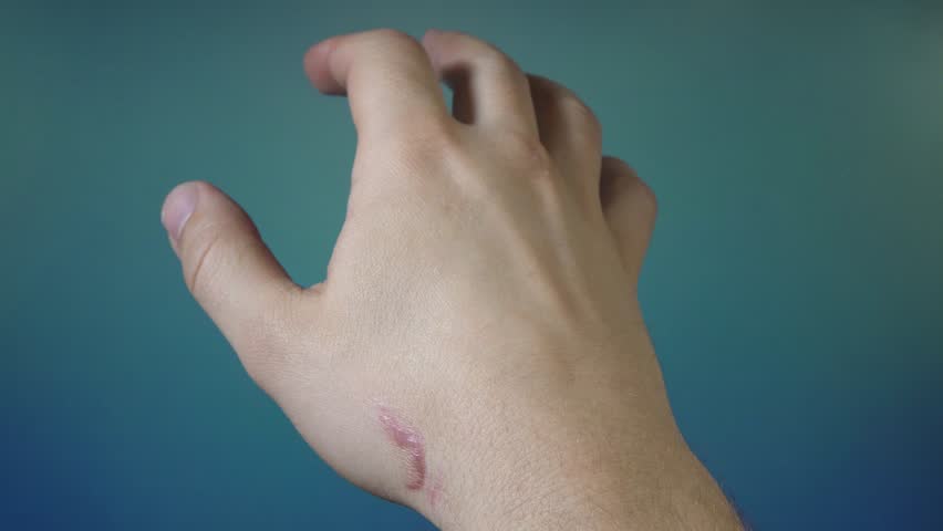 scar dog bite on arm Stock Footage Video (100% Royalty-free) 1008273646 ...