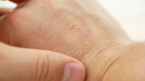 Skinning On Hand Fingers Scratch Hand Stock Footage Video (100% Royalty ...