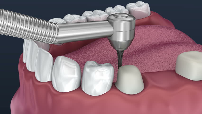 tooth supported fixed bridge 3 teeth Stock Footage Video (100% Royalty ...
