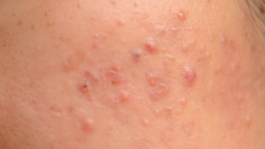 irritant contact dermatitis man leg close Stock Footage Video (100% ...