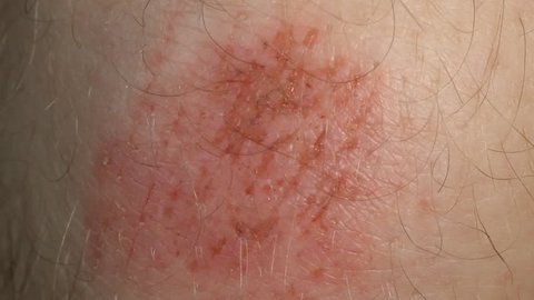 Carbuncle Leg Surrounding Cellulitis Stock Photo (Edit Now) 1174653358