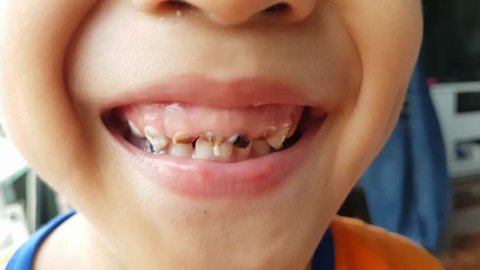 Rotten teeth child Stock Video Footage - 4K and HD Video Clips ...