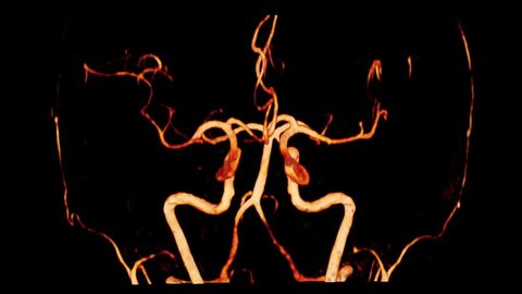 Magnetic Resonance Imaging Mri Angiography Willis Stock Footage Video ...