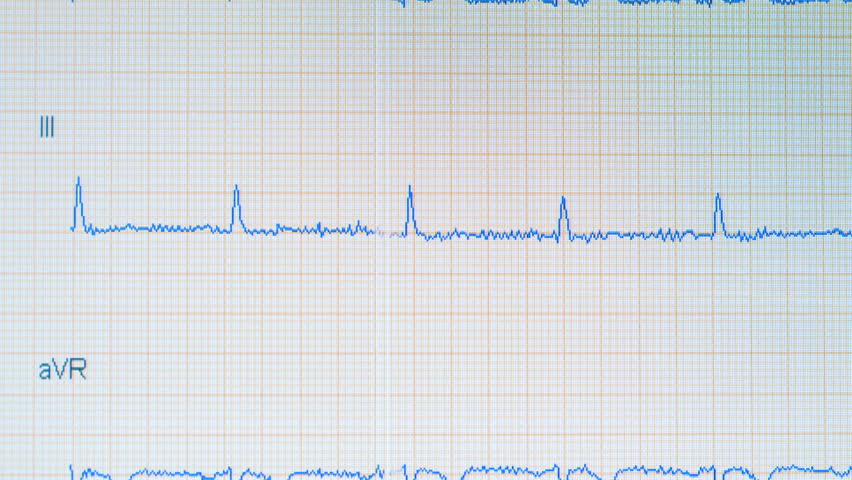 ekg graphic ecg monitor shows healthy Stock Footage Video (100% Royalty ...