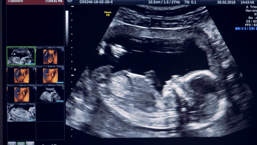 4,259 Children Ultrasound Stock Video Footage - 4K and HD Video Clips ...