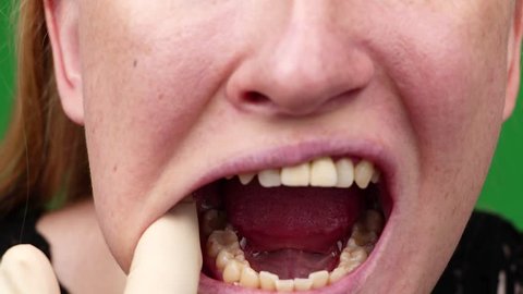 Hand Examining Large Abscess Lower Lip Stock Photo (Edit Now) 1638726577