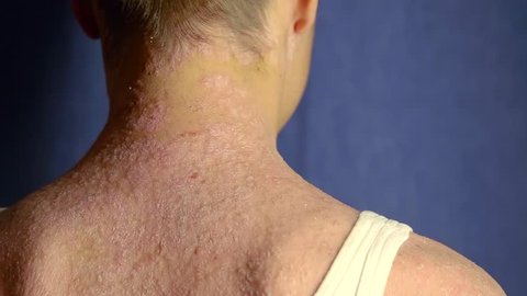 Dry Scaly Skin On Back Male Stock Footage Video (100% Royalty-free ...