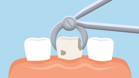 Tooth Extraction Dental Animation Reception Dentist Stock Footage Video ...