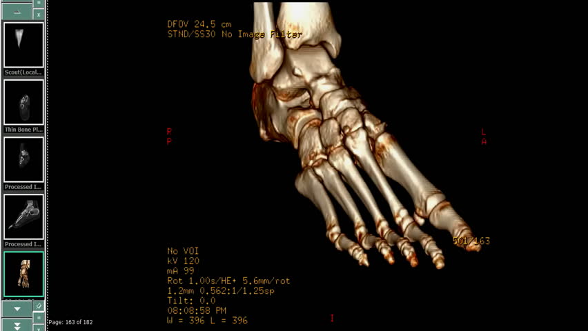 Ct Scan of Right Foot Stock Footage Video (100% Royalty-free ...