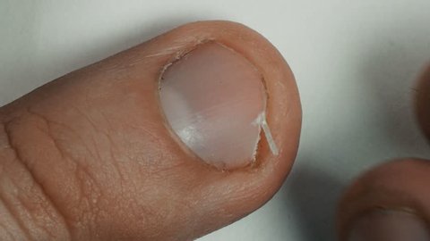 Vertical Ridges On Fingernails Symptoms Deficiency Stock Photo ...