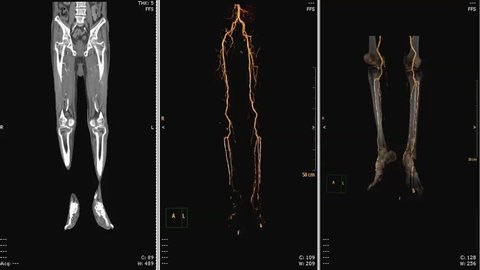 Computed Tomography Angiography Cta Lower Extremity Stock Footage Video ...