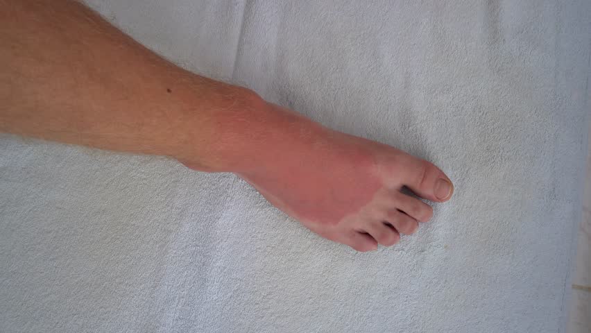 man's sunburned foot 4k Stock Footage Video (100% Royalty-free ...
