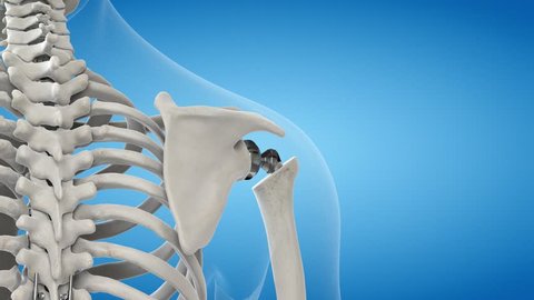 3d Rendered Animation Shoulder Replacement Stock Footage Video (100% ...