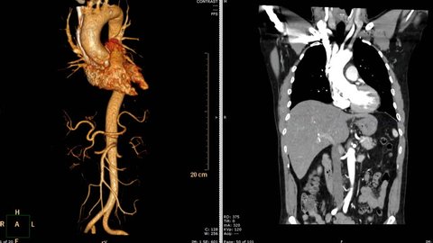Computed Tomographic Angiography Cta Thoracic Aorta Stock Footage Video ...