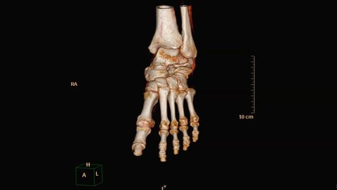 Ct Scan Left Foot 3d Rendering Stock Footage Video (100% Royalty-free ...