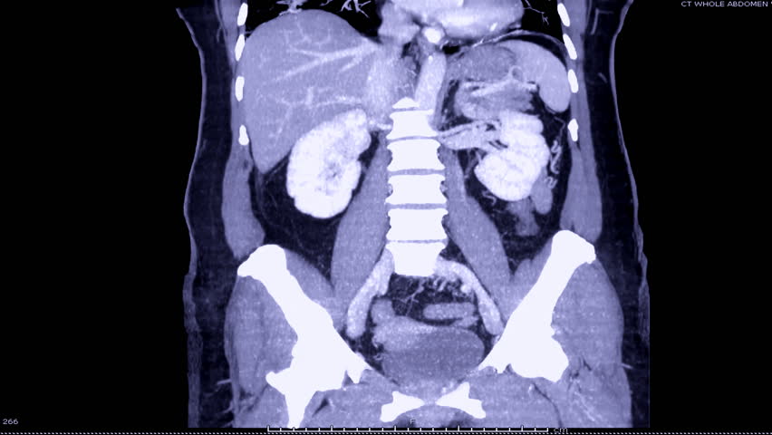 ct scan urinary system urography comparison Stock Footage Video (100% ...