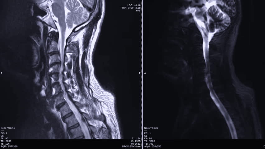 mri cervical spine myelogram on sagittal Stock Footage Video (100% Royalty-free) 1019882653 ...