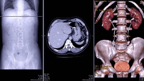 Ct Scan Urinary System Ct Urography Stock Footage Video (100% Royalty ...