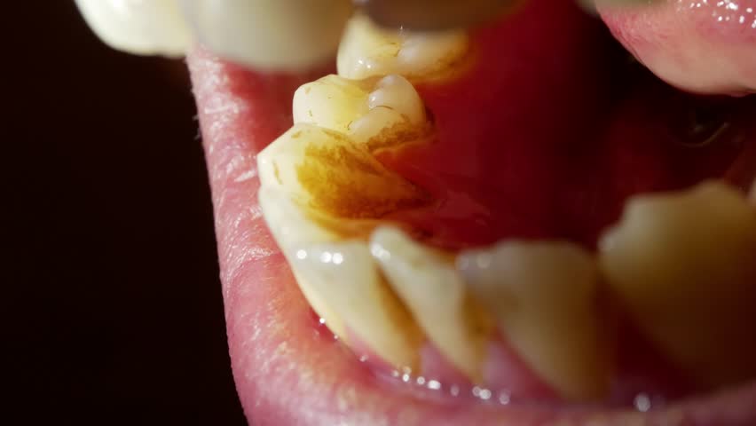 Detail Dental Calculus Tartar On Teeth Stock Footage Video (100% ...