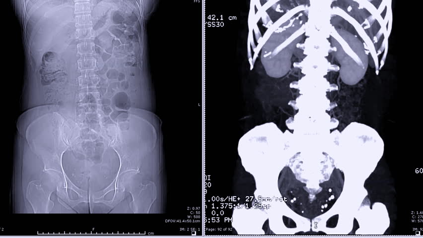 ct scan urinary system urography comparison Stock Footage Video (100% ...
