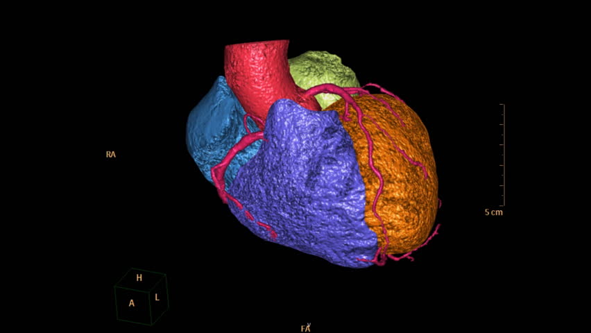 Coronary Ct Scan Stock Video Footage - 4K and HD Video Clips | Shutterstock