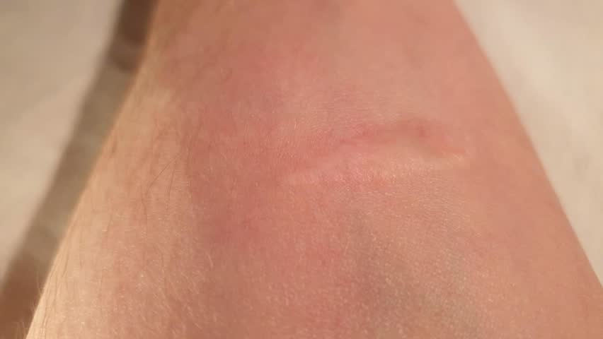 Skin splice Stock Video Footage - 4K and HD Video Clips | Shutterstock