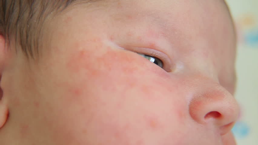 hormonal rashes newborns nose hand eye Stock Footage Video (100% ...