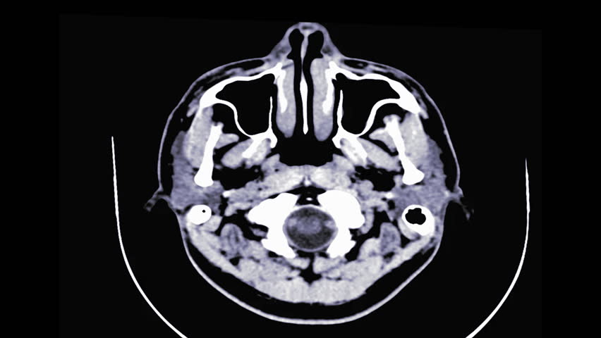 ct scan brain axial view diagnosis Stock Footage Video (100% Royalty ...