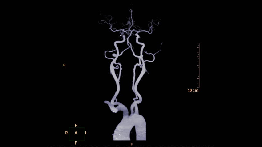 Ct Angiography or Cta Brain Stock Footage Video (100% Royalty-free ...