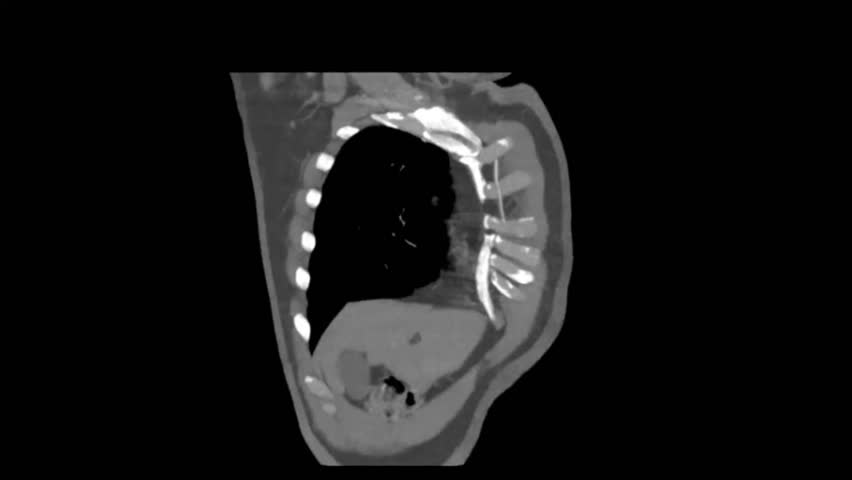 arterial phase oblique angiotac thorax Stock Footage Video (100% ...