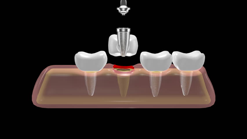 3d animation dental implant fixing fixture Stock Footage Video (100% ...