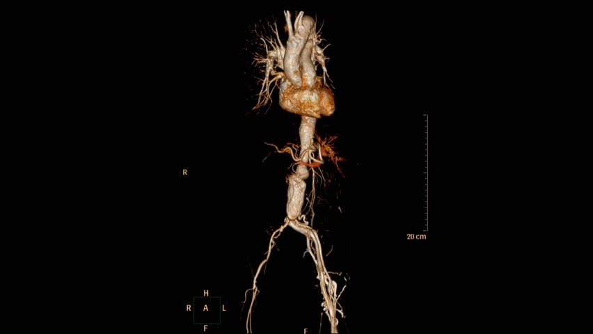 Arteriovenous graft Stock Video Footage - 4K and HD Video Clips ...