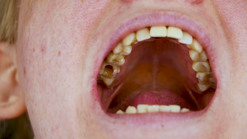 The Hole in the Tooth Stock Footage Video (100% Royalty-free ...