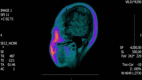 Real Life Man Brain Mri Scan Stock Footage Video (100% Royalty-free ...