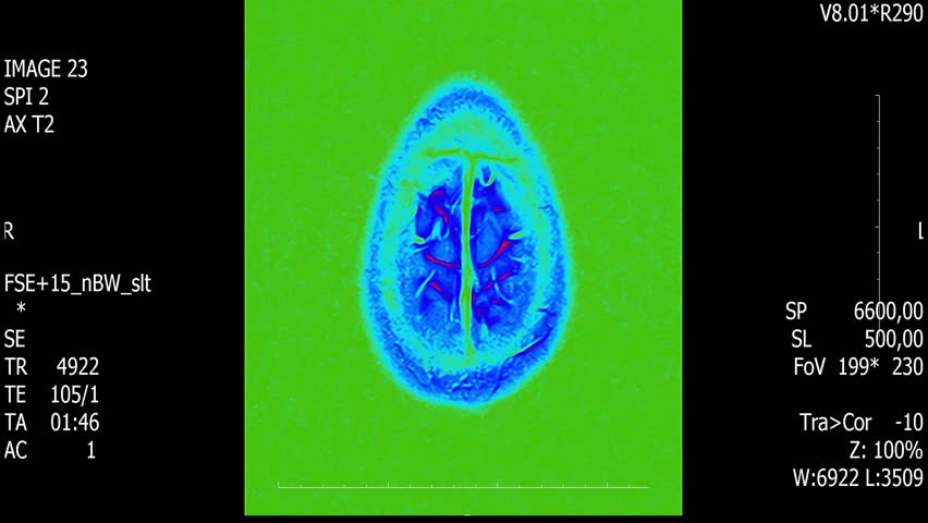 Real Life Man Brain Mri Stock Footage Video (100% Royalty-free ...