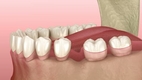 Malocclusion Problems Bad Bite Infographic Orthodontic Stock Vector ...