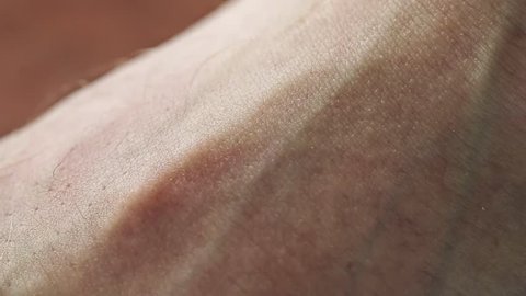 Patient Had Abscess On His Arm Stock Photo (Edit Now) 2034725768