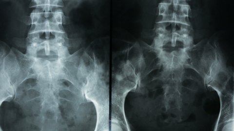 Xray Lumbosacral Spine Normal Perfect Stock Photo 1290672328 | Shutterstock