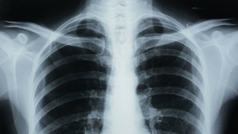 Chest Xray Vascular Access Permacath Insertion Stock Photo 1593331306 ...