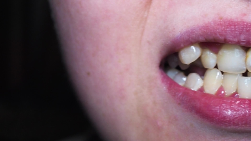 Orthodontics Braces. Bad Teeth Needing Stock Footage Video (100% ...