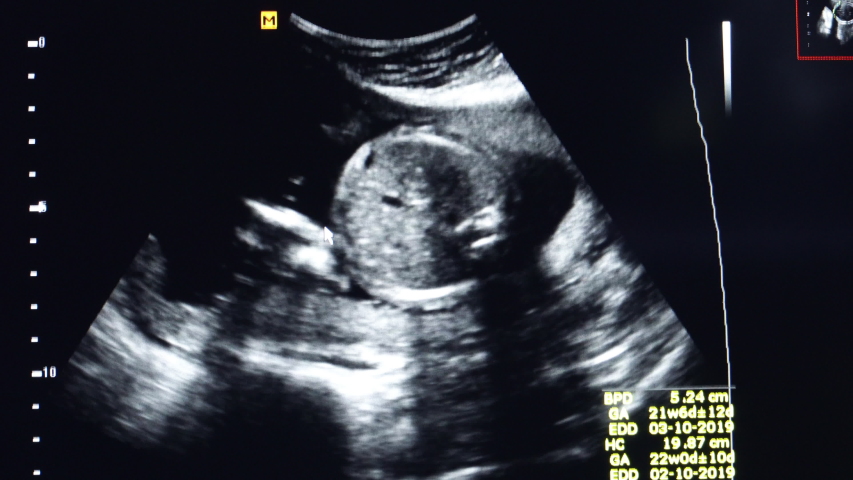 23 Weeks Old Fetus in Stock Footage Video (100% Royalty-free ...