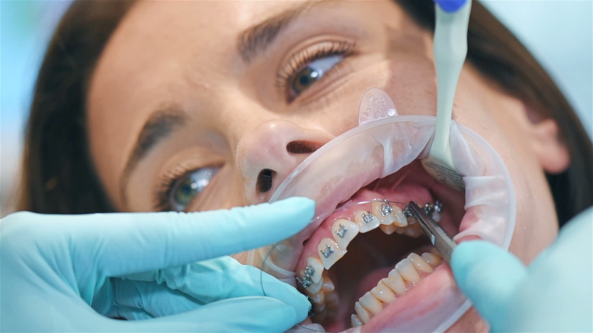 Dentist Installs Arc On Patient Stock Footage Video (100% Royalty-free ...