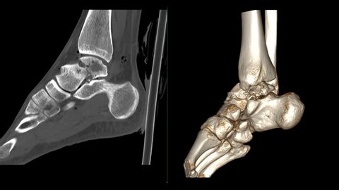 Ct scan leg Stock Video Footage - 4K and HD Video Clips | Shutterstock
