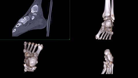 Ct scan leg Stock Video Footage - 4K and HD Video Clips | Shutterstock
