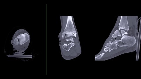 Ct scan leg Stock Video Footage - 4K and HD Video Clips | Shutterstock