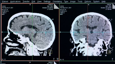 Head Scan Close Screen Head Scanning Stock Footage Video (100% Royalty ...